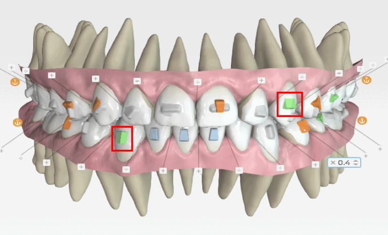 Lançamentos Spark™ – Atualizações de Alinhadores Spark