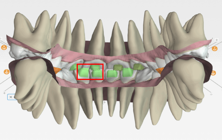 Lançamentos Spark™ – Atualizações de Alinhadores Spark