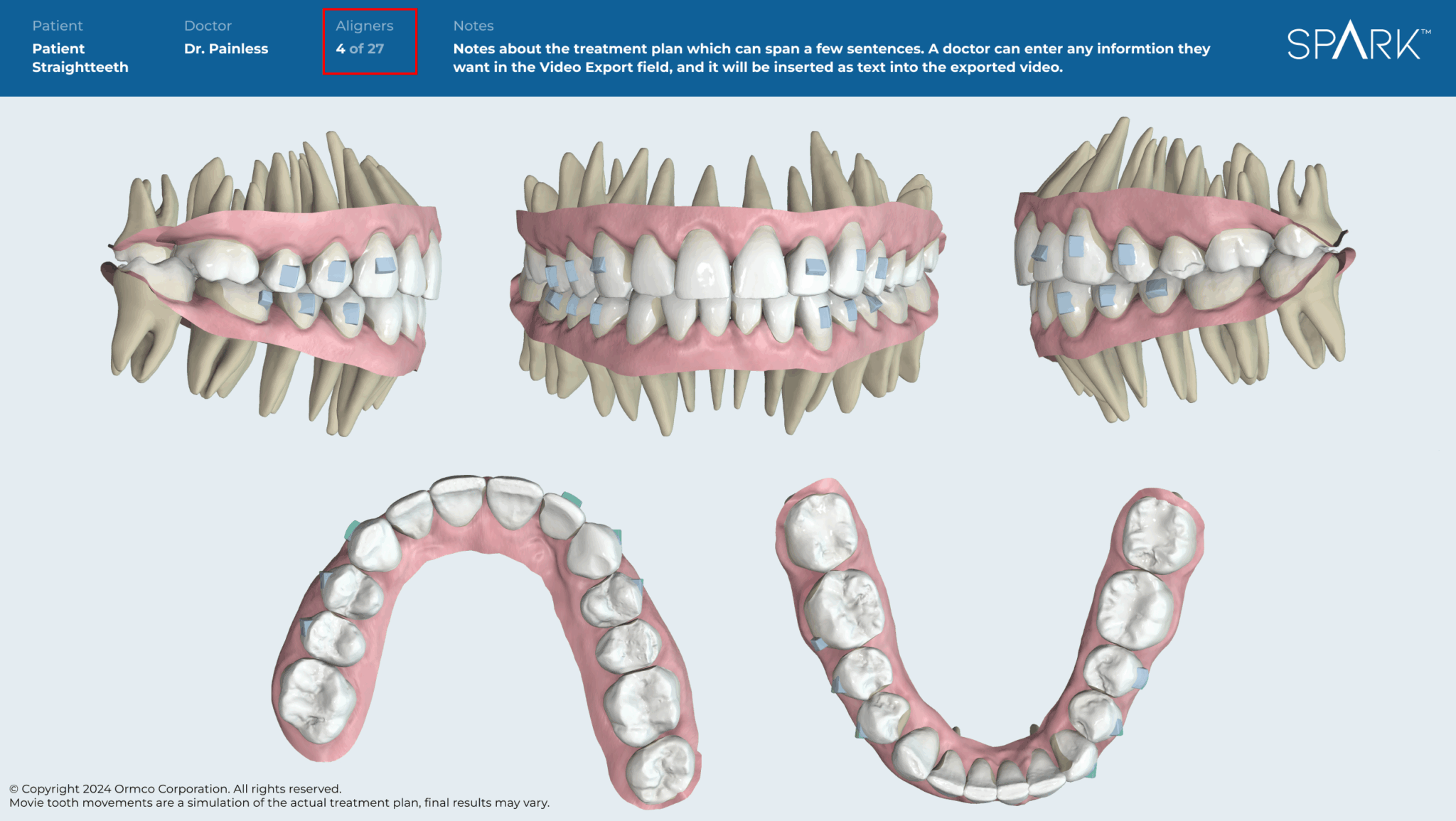 Lançamentos Spark™ – Atualizações de Alinhadores Spark